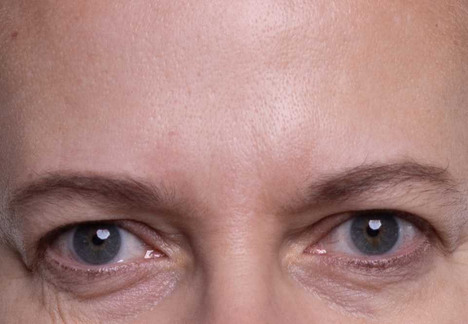 Silicone Patches for Wrinkles Before and After – Wrinkles Schminkles